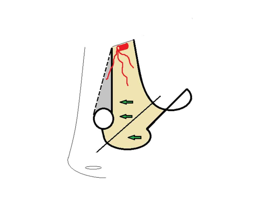 Perforación del tabique: ya no es la cirugía evitada | Volta