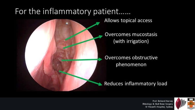 Modern Treatment For Nasal Polyps And Sinusitis
