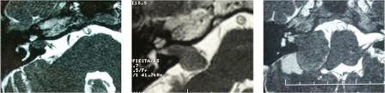 Vestibular Schwannoma (Acoustic Neuroma) - Sydney ENT Clinic
